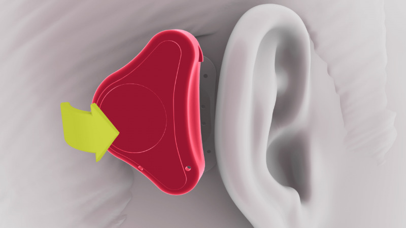 What happens if my child has a hearing loss? - Audiology (Hearing ...